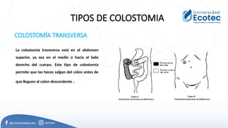 CLASE DE OSTOMIA y cuidados en su cirugia.pptx