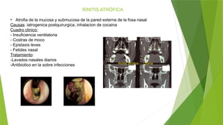 clase de rinitis - dr sebastian.pptx otorrino | PPTX
