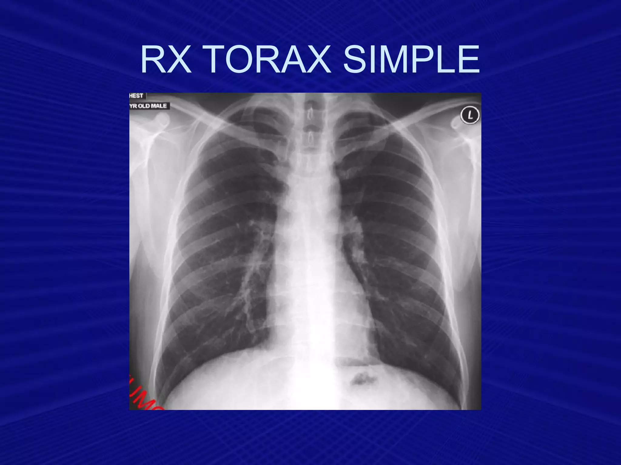 Clase de torax | PPT