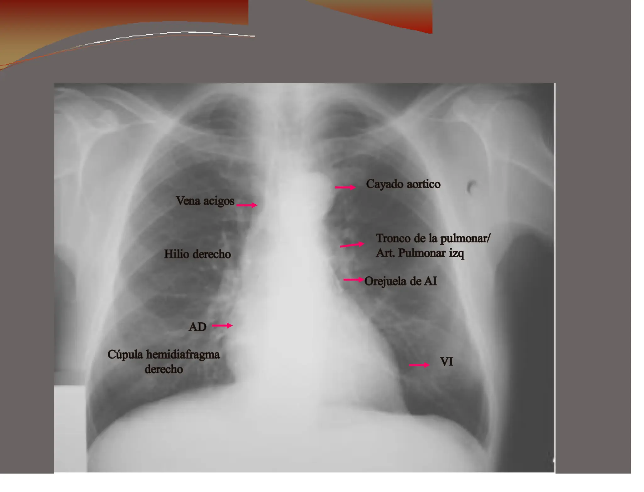 Parametros y patología de Tórax. En radiologia | PPT