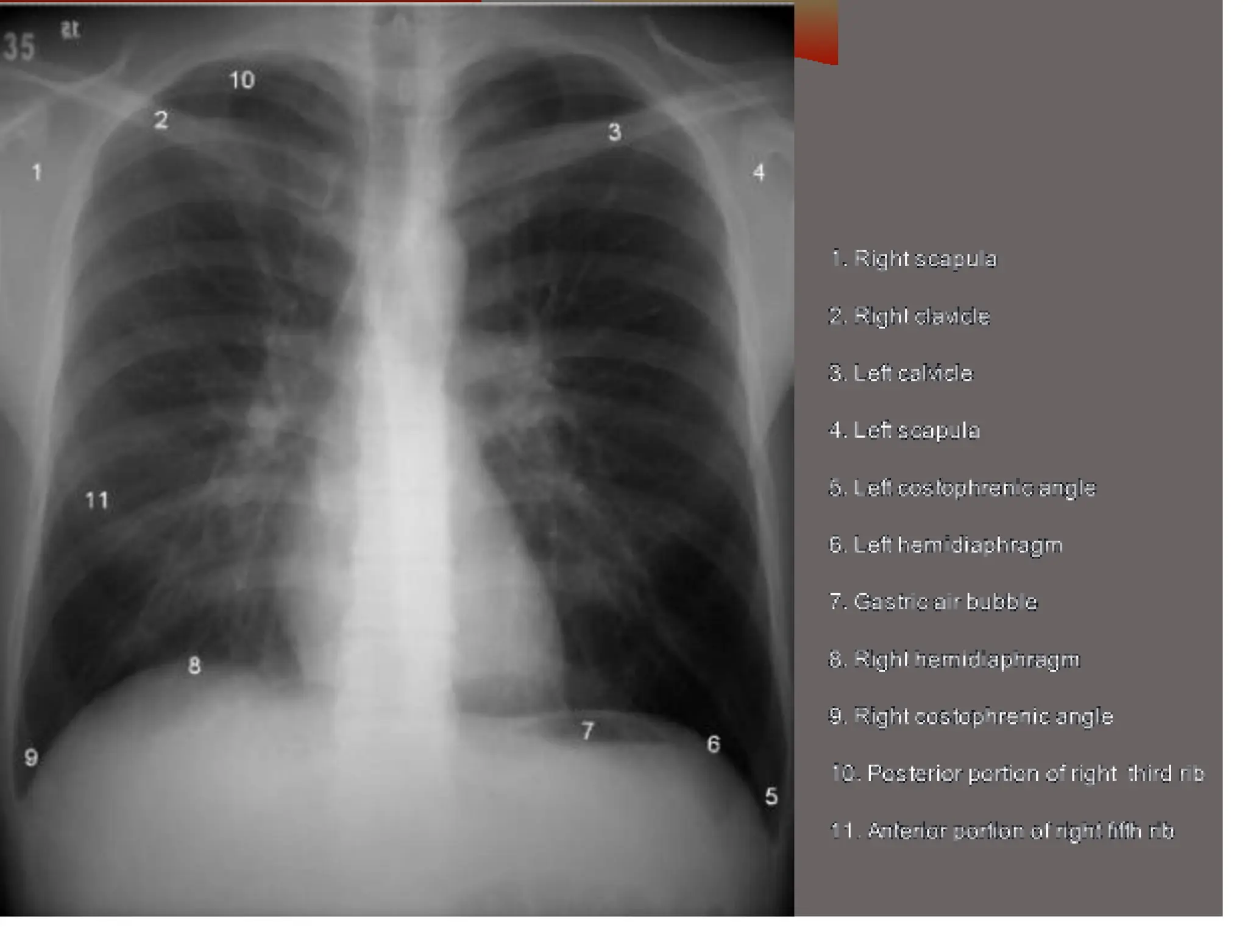 Parametros y patología de Tórax. En radiologia | PPT