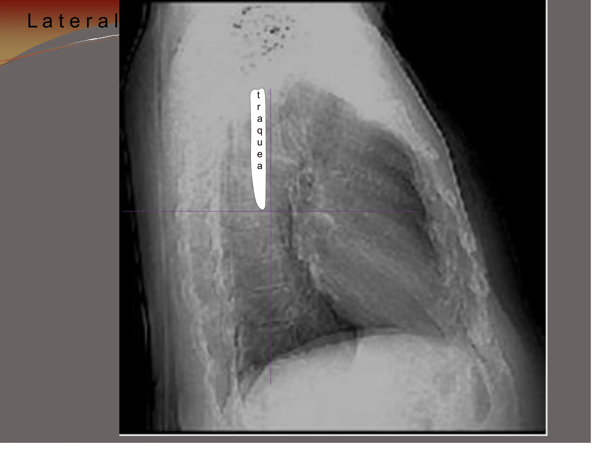 Parametros y patología de Tórax. En radiologia | PPT