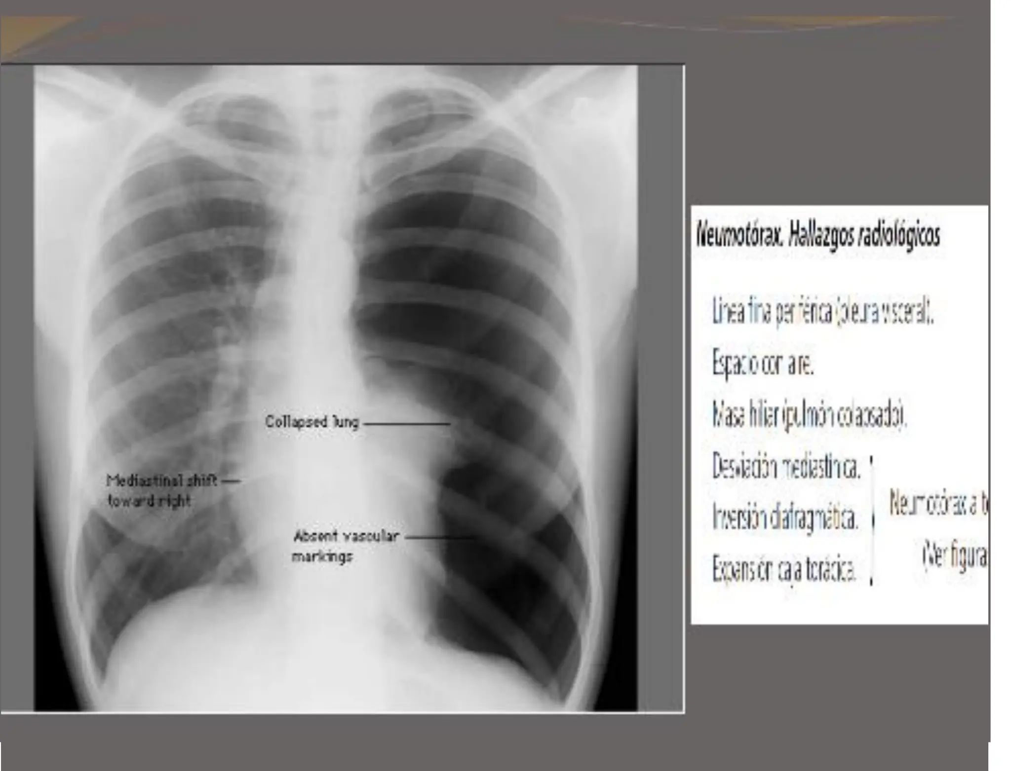 Parametros y patología de Tórax. En radiologia | PPT