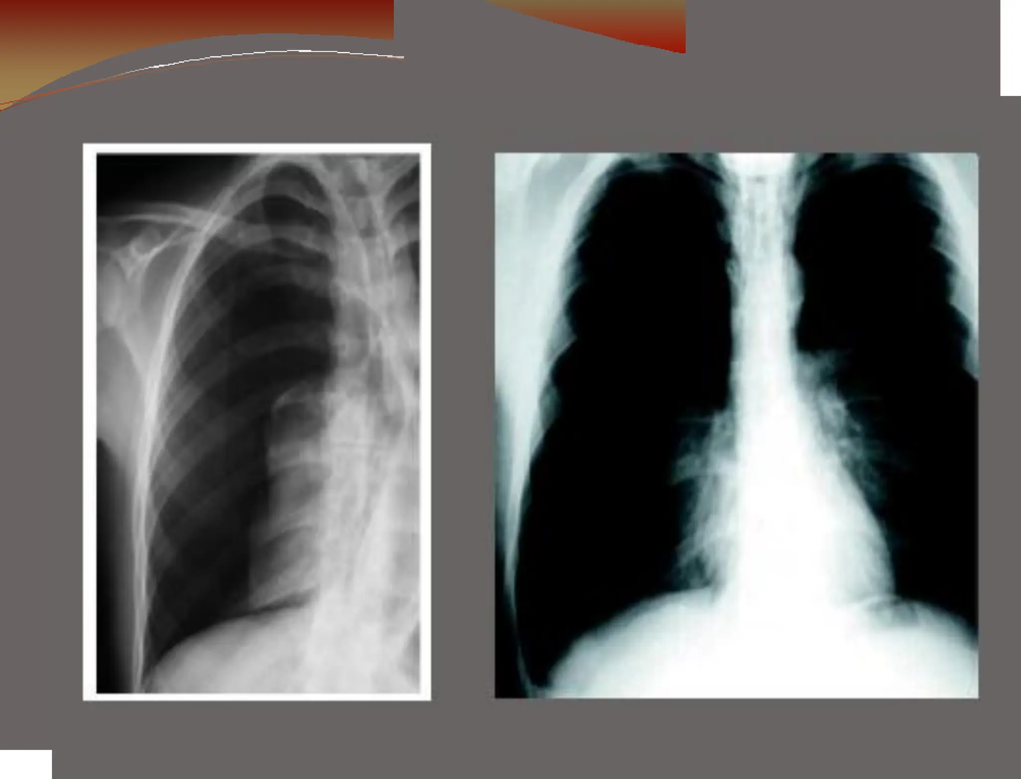 Parametros y patología de Tórax. En radiologia | PPT