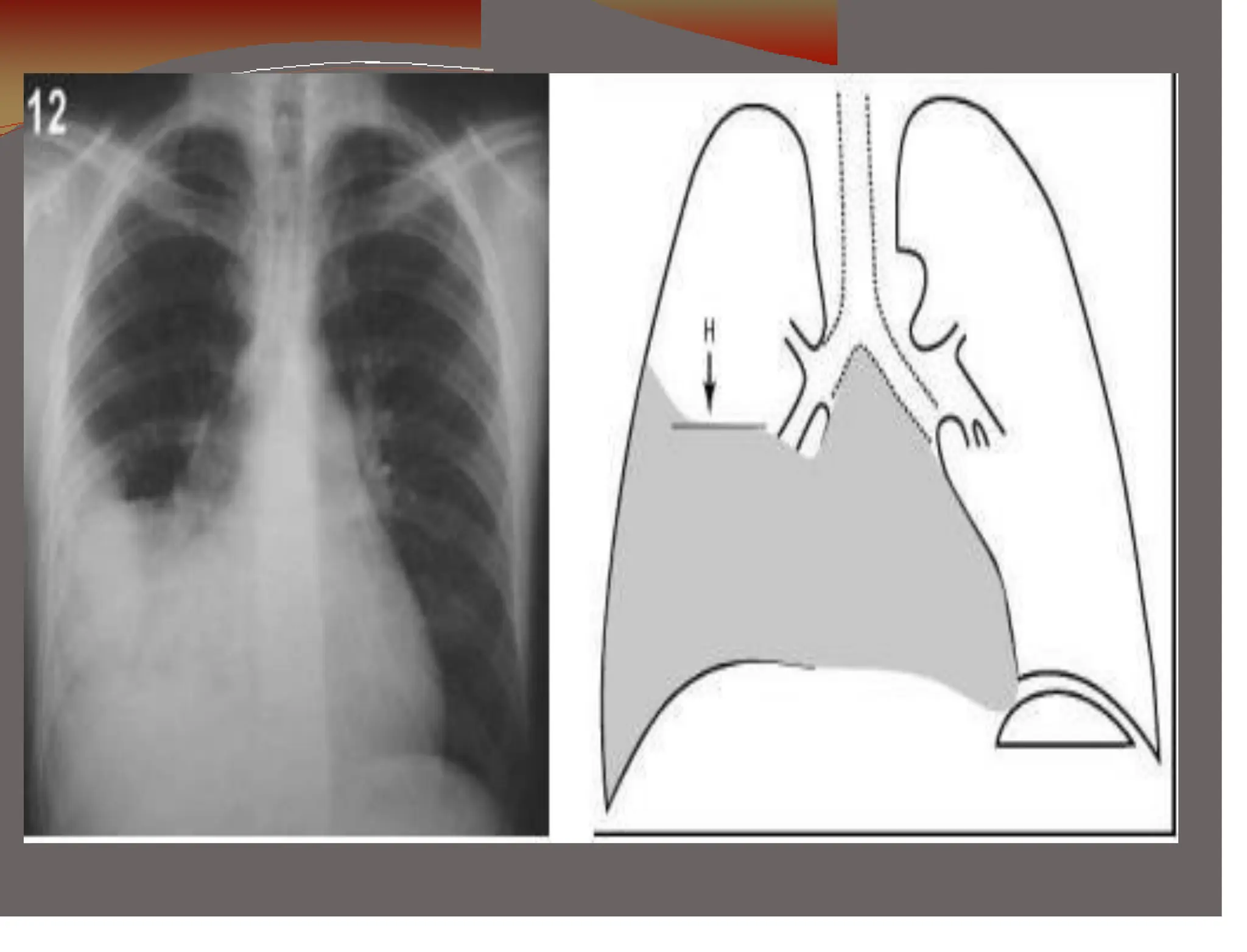 Parametros y patología de Tórax. En radiologia | PPT