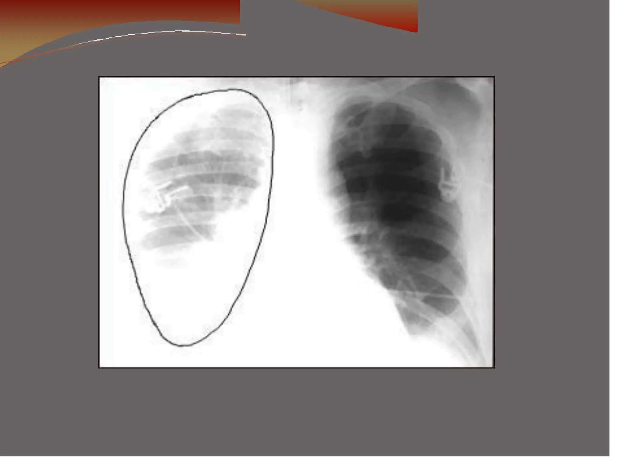 Parametros y patología de Tórax. En radiologia | PPT