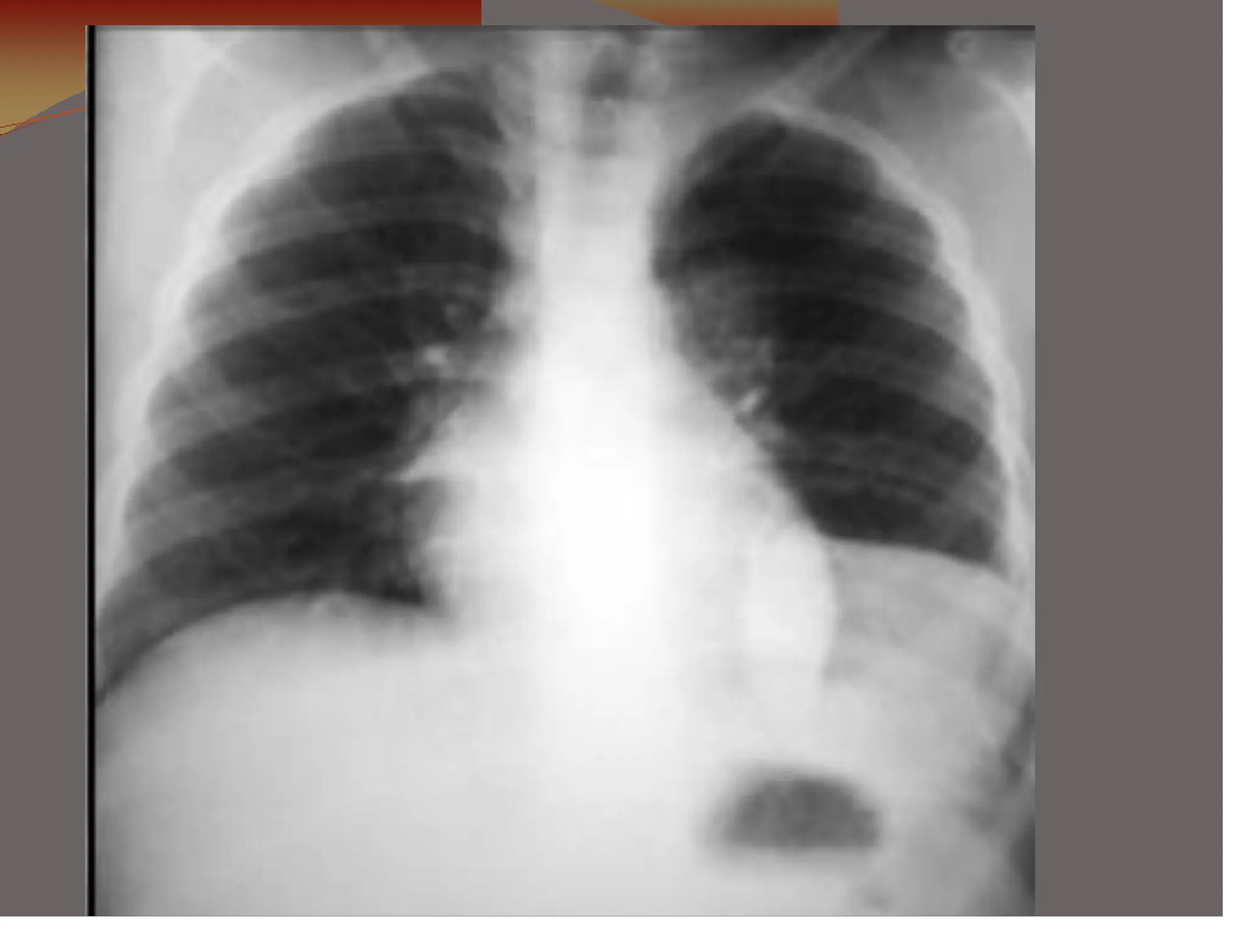Parametros y patología de Tórax. En radiologia | PPT