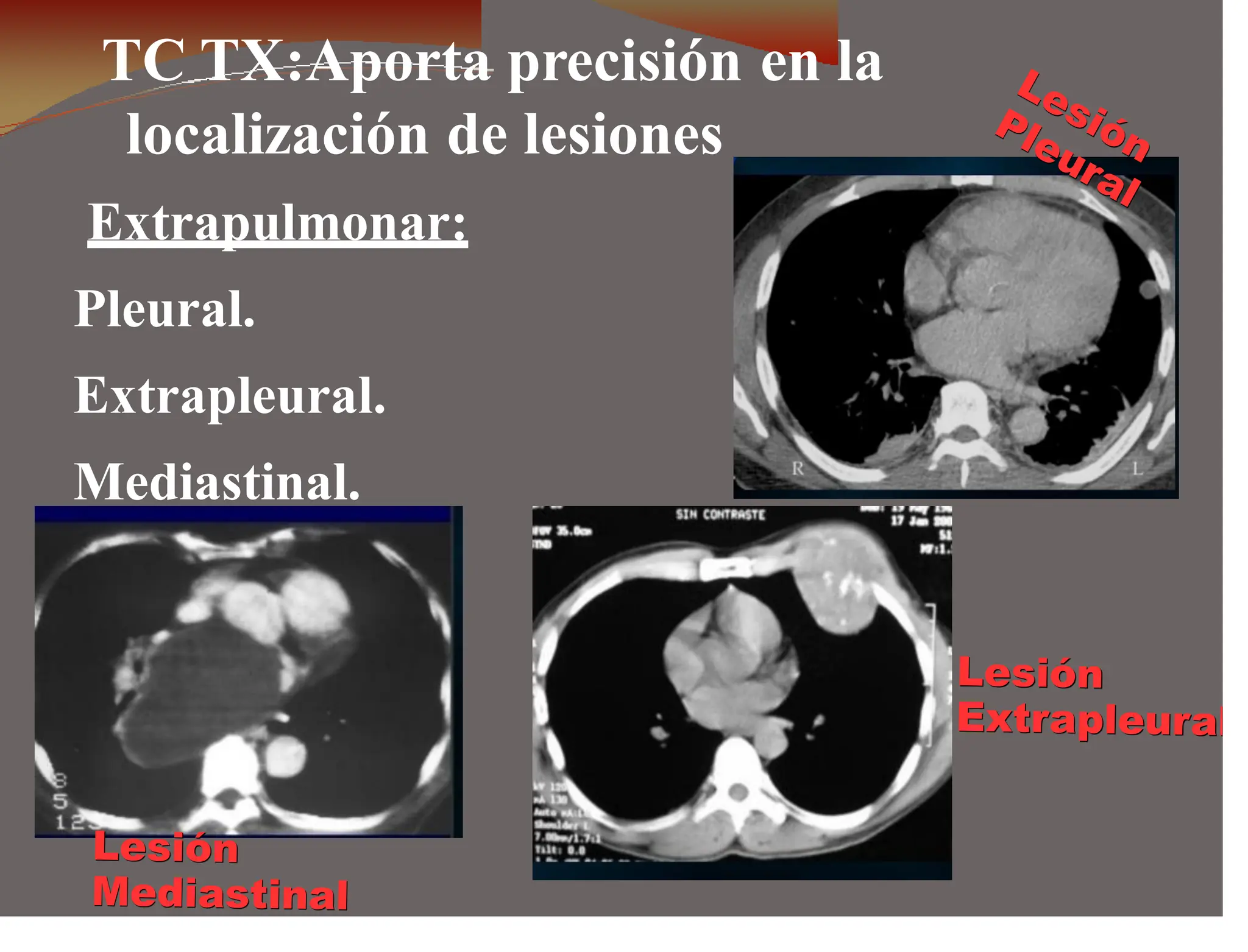Parametros y patología de Tórax. En radiologia | PPT