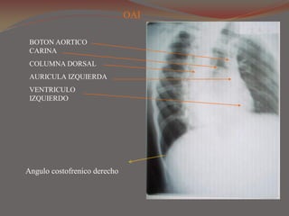 Clase de torax fisiopatologia completo (1).pdf