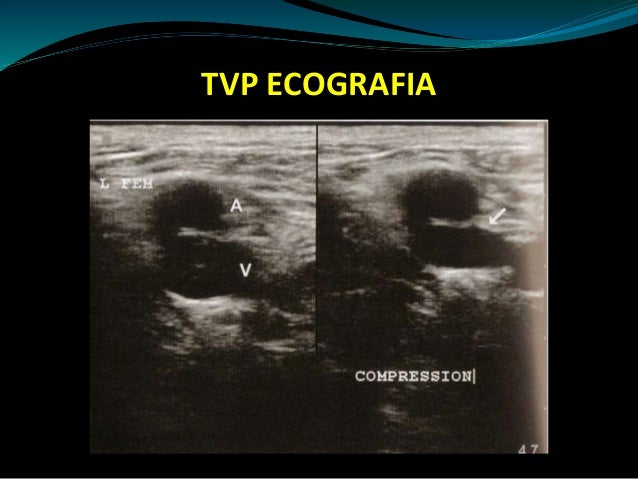 Clase de trombosis venosa profunda 2014