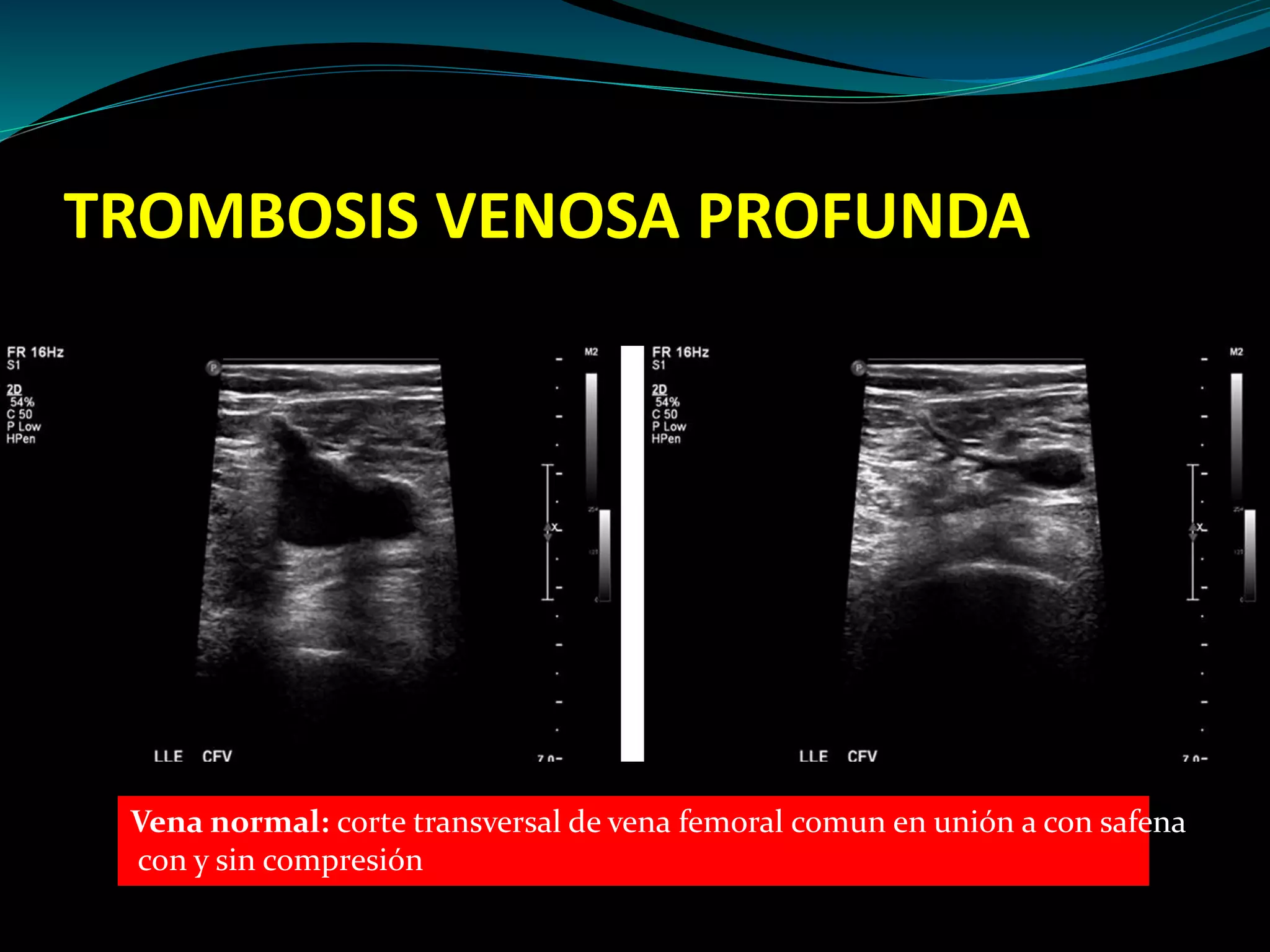 Clase de trombosis venosa profunda 2015 | PPTX