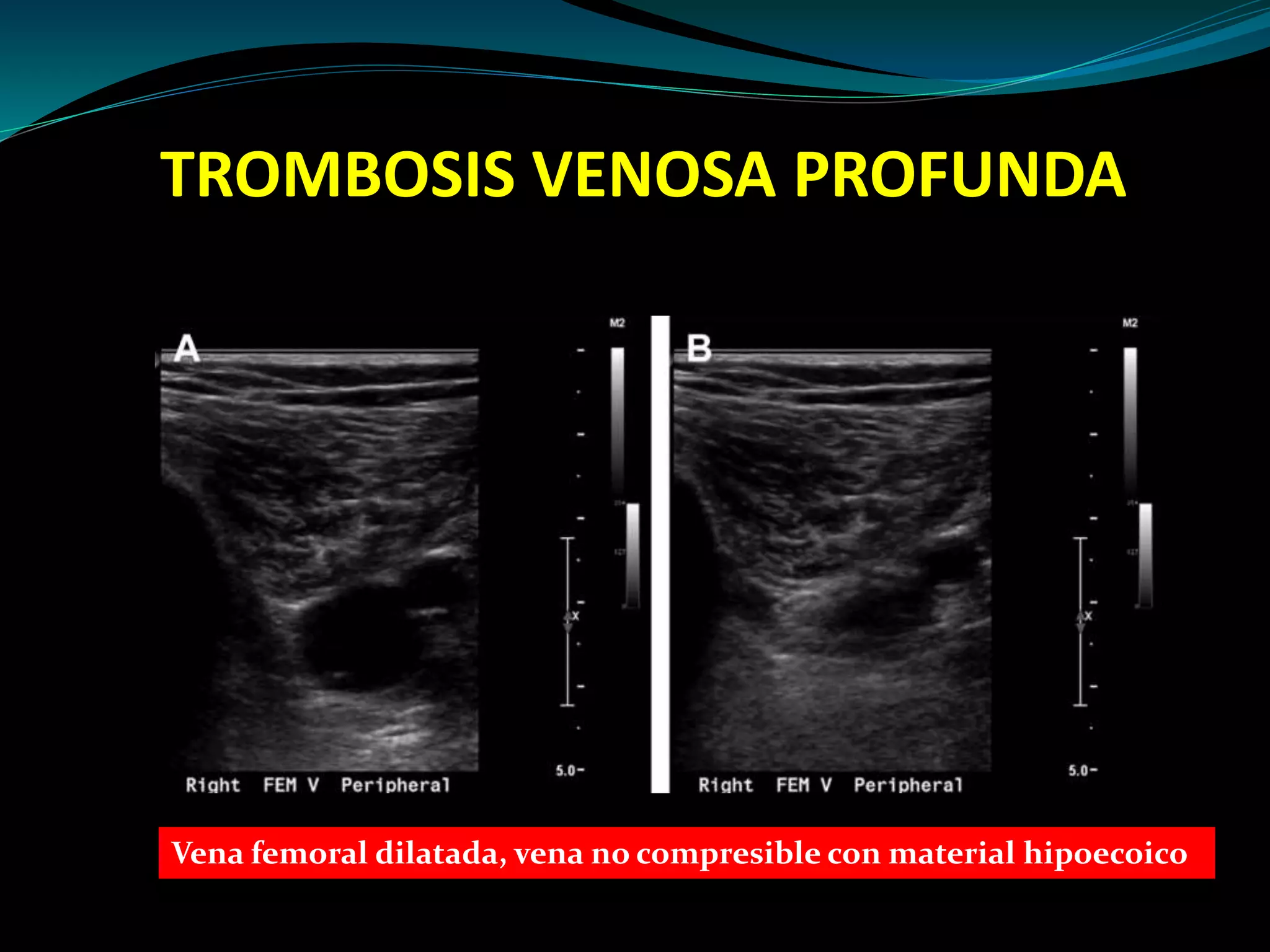 Clase de trombosis venosa profunda 2015 | PPTX