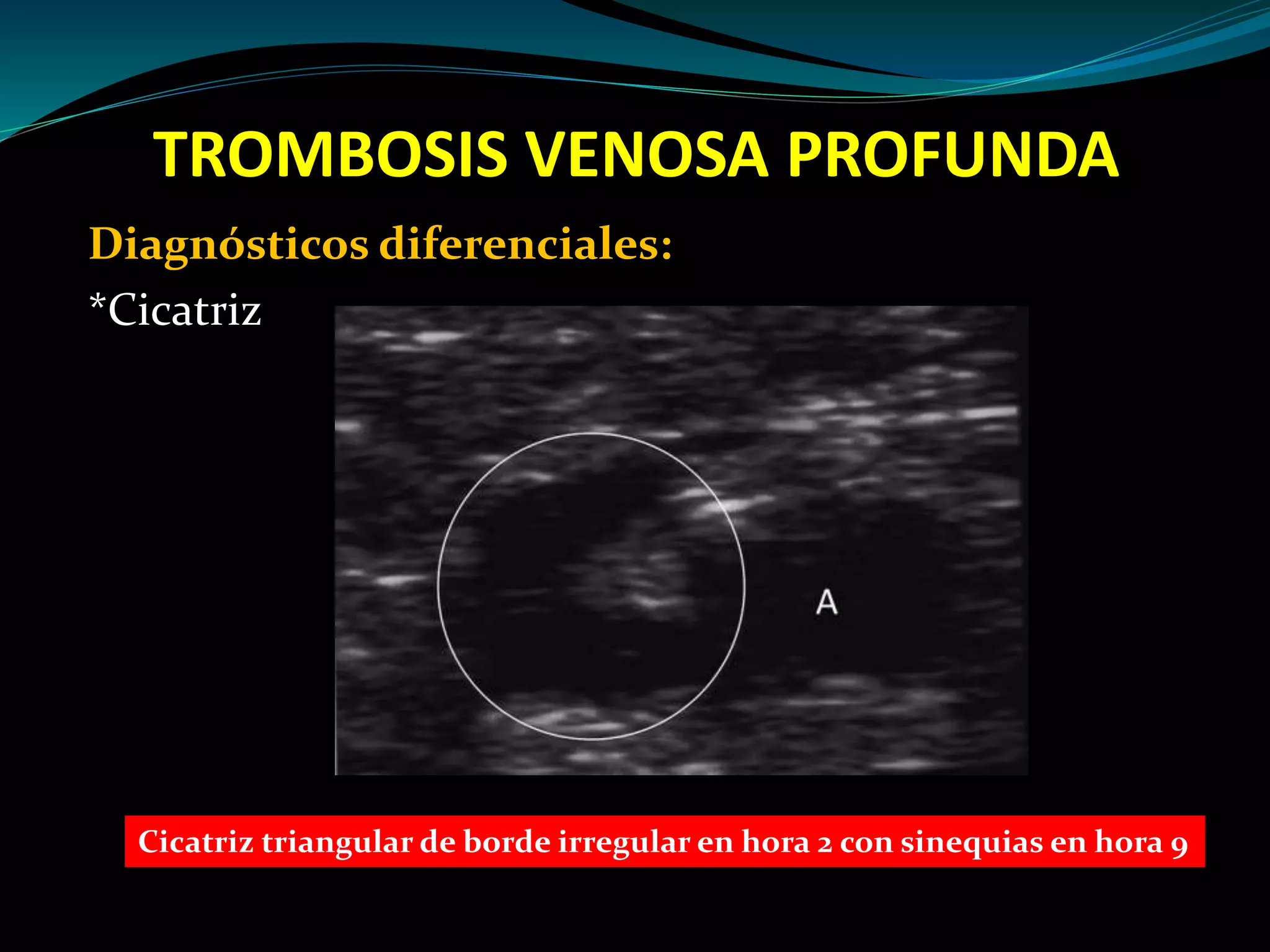 Clase de trombosis venosa profunda 2015 | PPTX