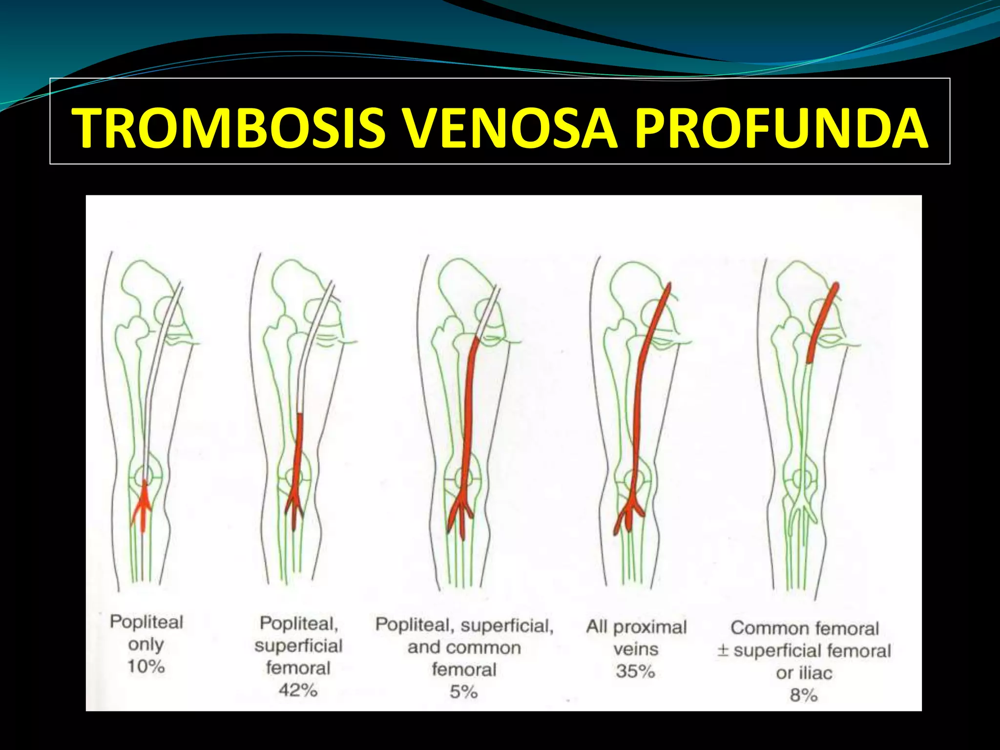 Clase de trombosis venosa profunda 2015 | PPTX