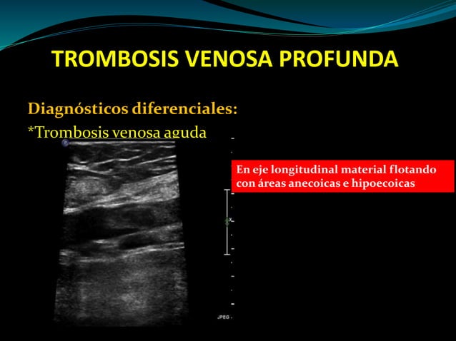 Clase de trombosis venosa profunda 2015 | PPTX