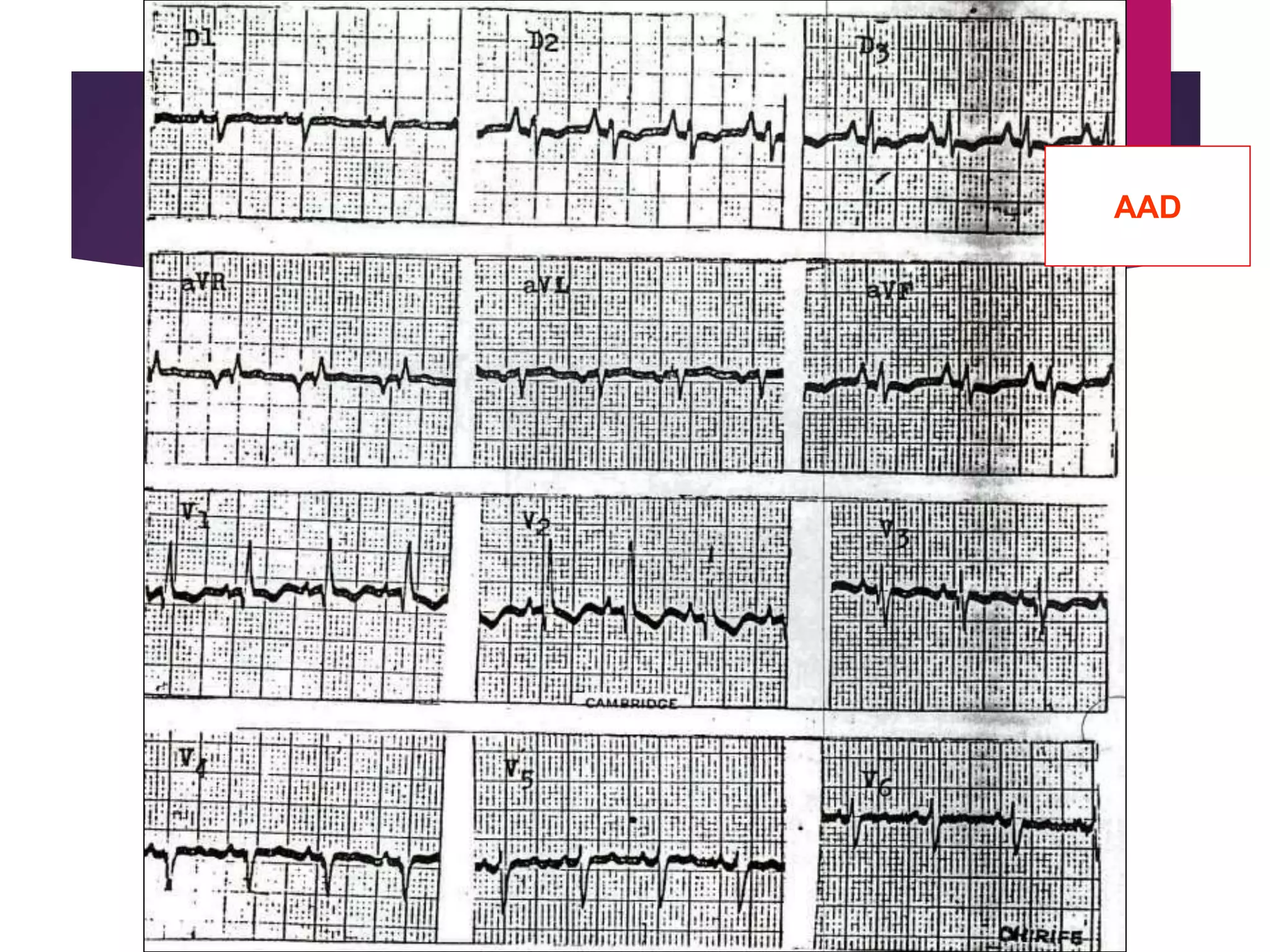 Clase ECG patológico | PPTX