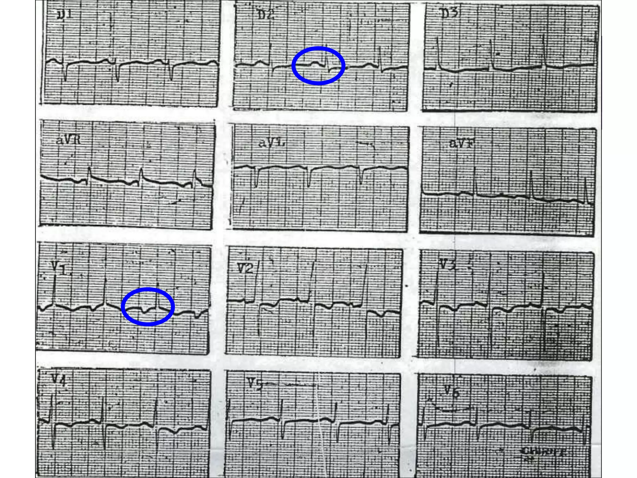 Clase ECG patológico | PPTX