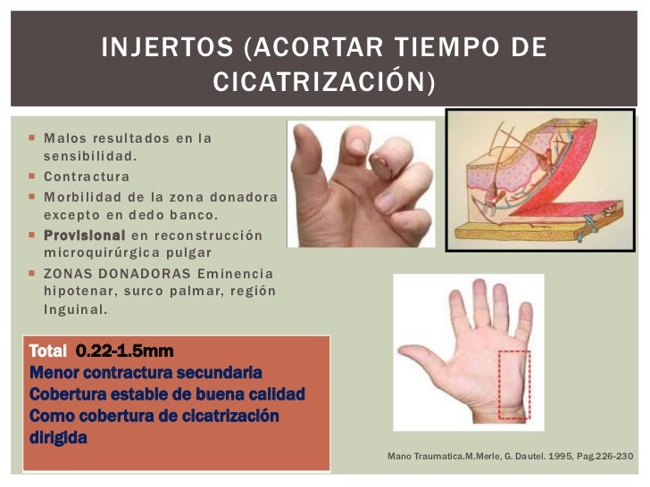 Reconstrucción de punta digital.