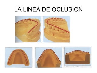 Clase ii caso clinico | PDF