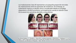 Manejo de maloclusion clase III con tecnica de roth.pptx
