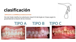 CLASE II tratamiento ortodonticoooo.pptx