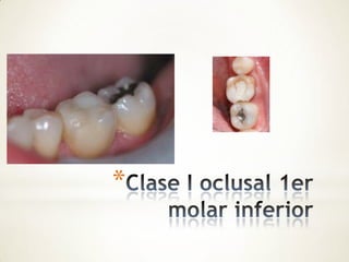 Clase I Oclusal en Segundo Molar Inferior Izquierdo | PPTX