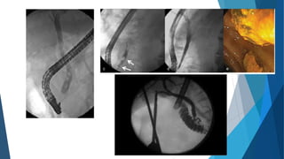 LITIASIS COLEDOCIANA.pptx