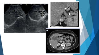 LITIASIS COLEDOCIANA.pptx