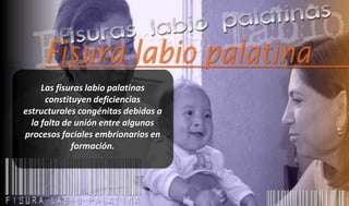 Fisura Labiopalatina y Labio Leporino | PPSX