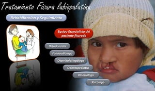 Fisura Labiopalatina y Labio Leporino | PPSX