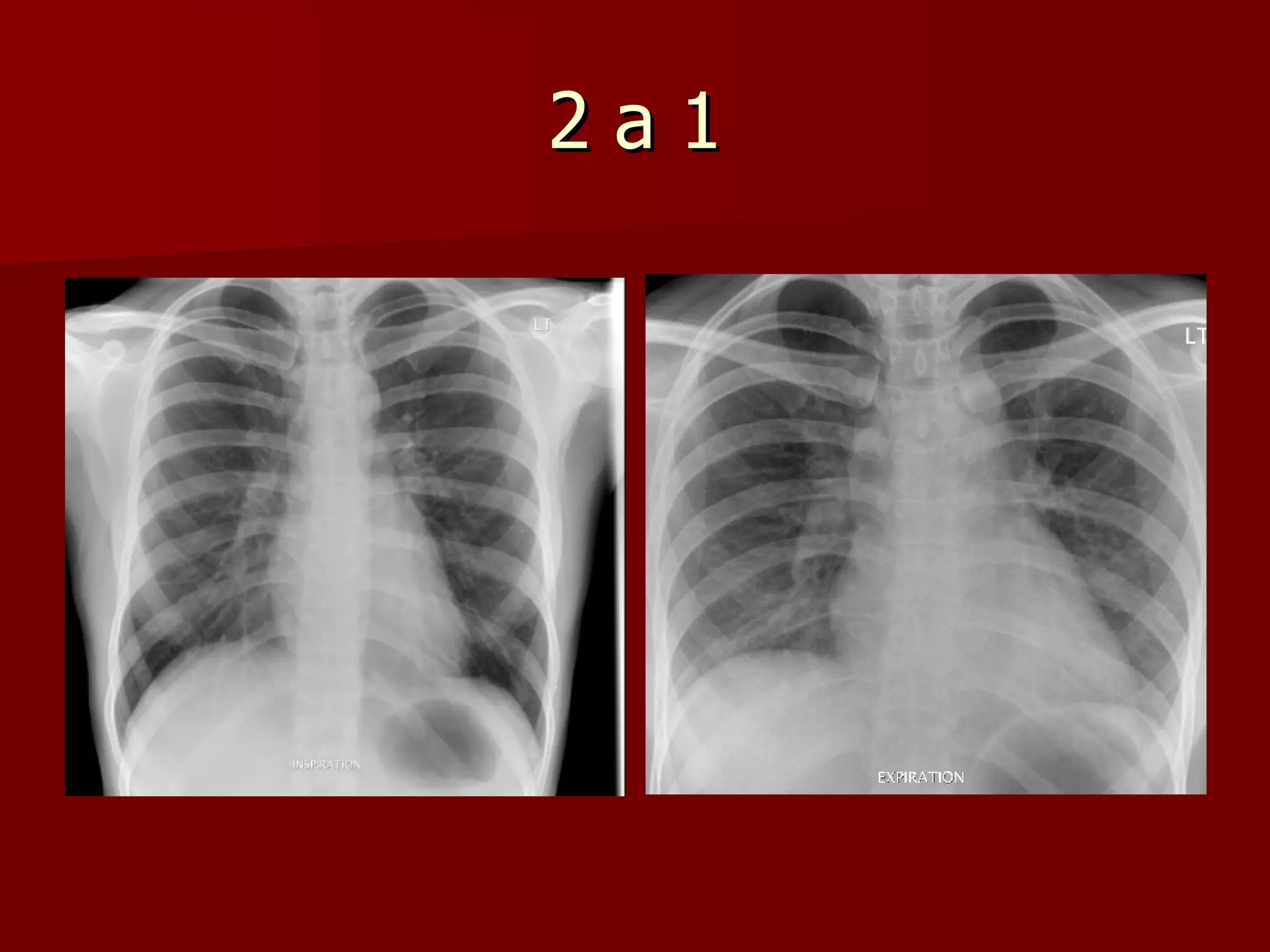 Clase pulmon normal | PPT