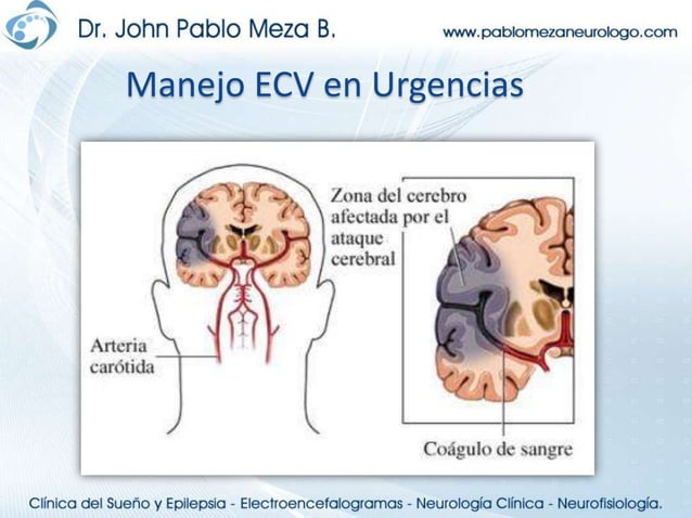 Clases clinica neurologia manejo acv urgencias | PPTX | Diseases and ...