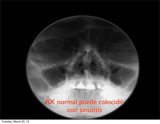 Clase sinusitis aguda y cronica 2012 | PDF