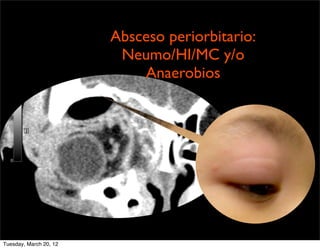 Clase sinusitis aguda y cronica 2012 | PDF