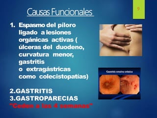 SINDROME PILORICO 2019 | PPTX
