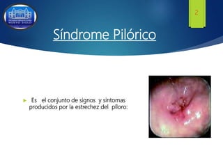 SINDROME PILORICO 2019 | PPTX
