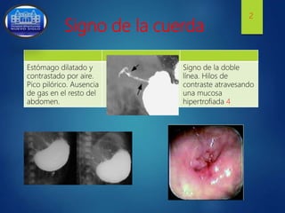 SINDROME PILORICO 2019 | PPTX
