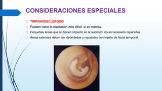 CIRUGIA DE TIMPANOPLASTIA Y OSICULOPLASTIA | PPTX