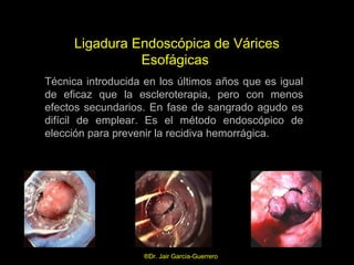 Várices esofágicas | PPT