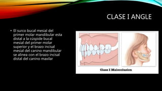 Clasificación angle maxi.pptx