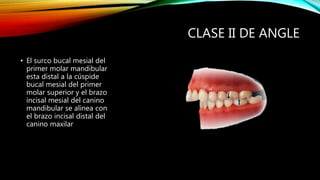 Clasificación angle maxi.pptx