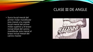 Clasificación angle maxi.pptx