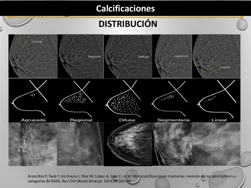Clasificación birads mx y usg