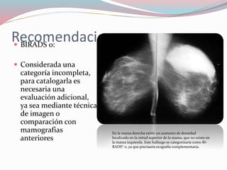 Clasificación birads | PPTX