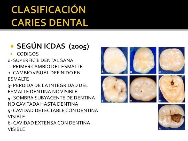 Clasificación de caries dental