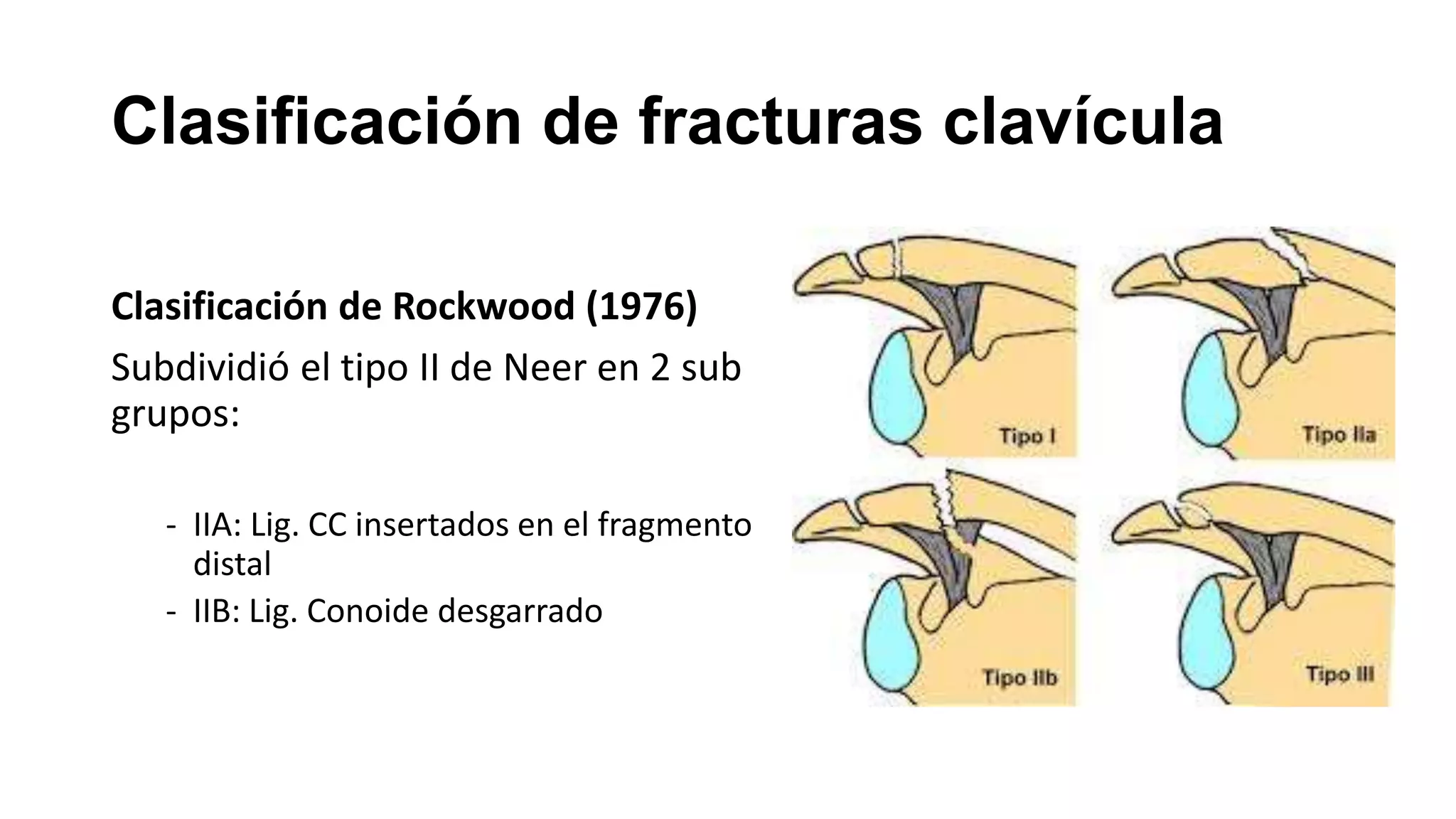 Clasificación de fracturas clavícula | PPTX