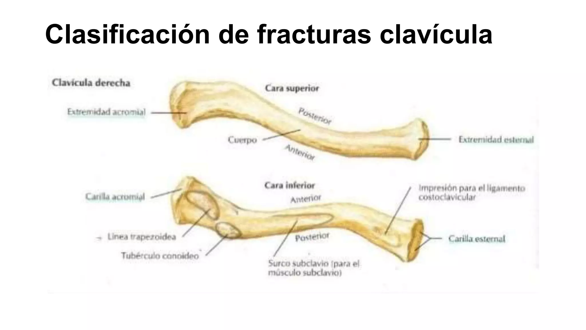 Clasificación de fracturas clavícula | PPTX