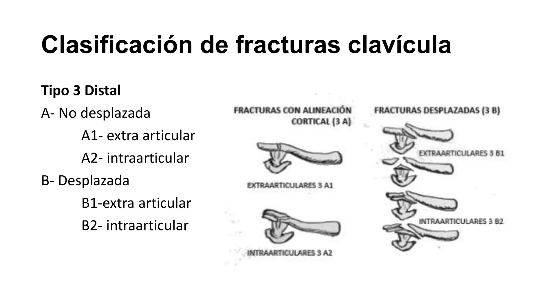 Clasificación de fracturas clavícula | PPTX
