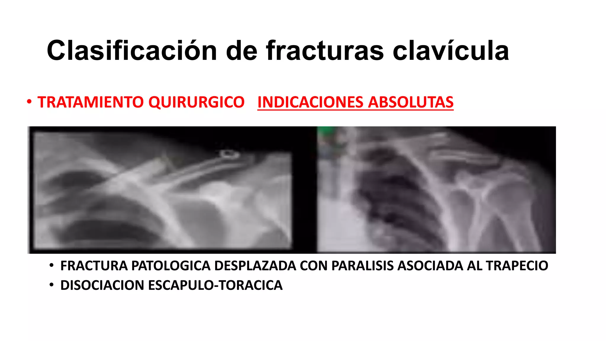Clasificación de fracturas clavícula | PPTX