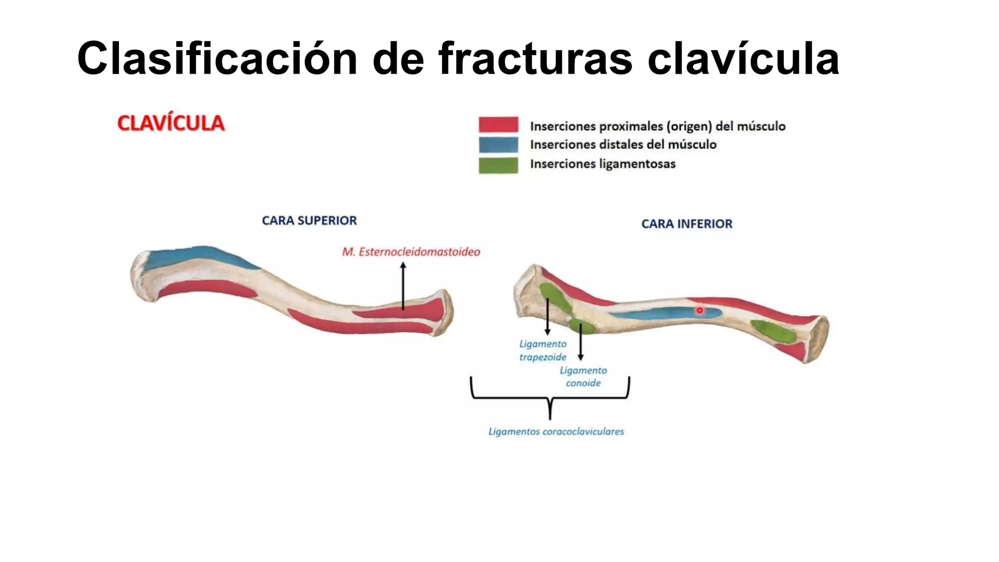 Clasificación de fracturas clavícula | PPTX